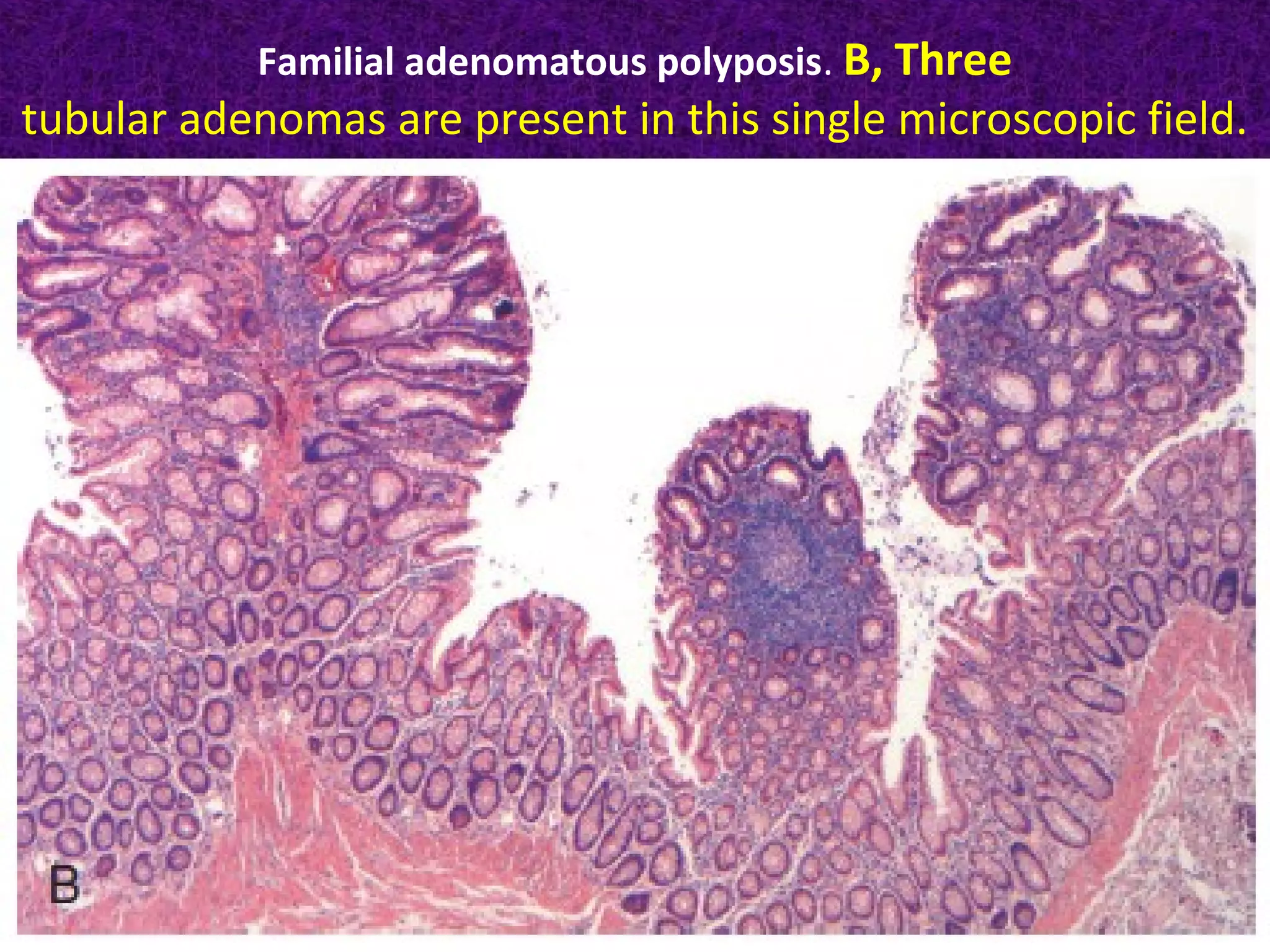Neoplastic Colonic polyps- Colonic Adenoma; Familial Syndromes | PPT