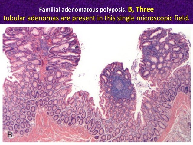 Neoplastic Colonic polyps- Colonic Adenoma; Familial Syndromes