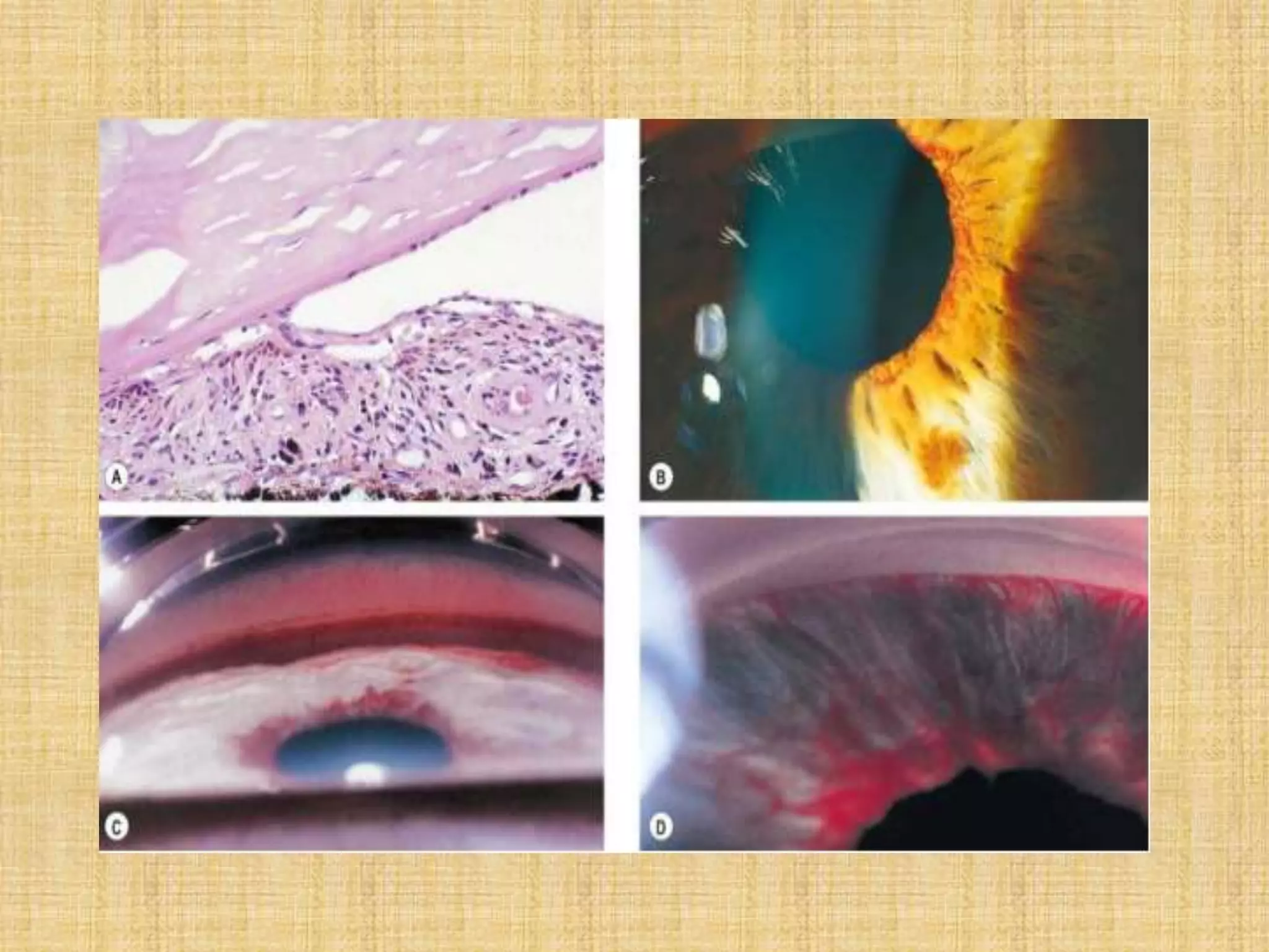 Neovascular glaucoma | PPTX