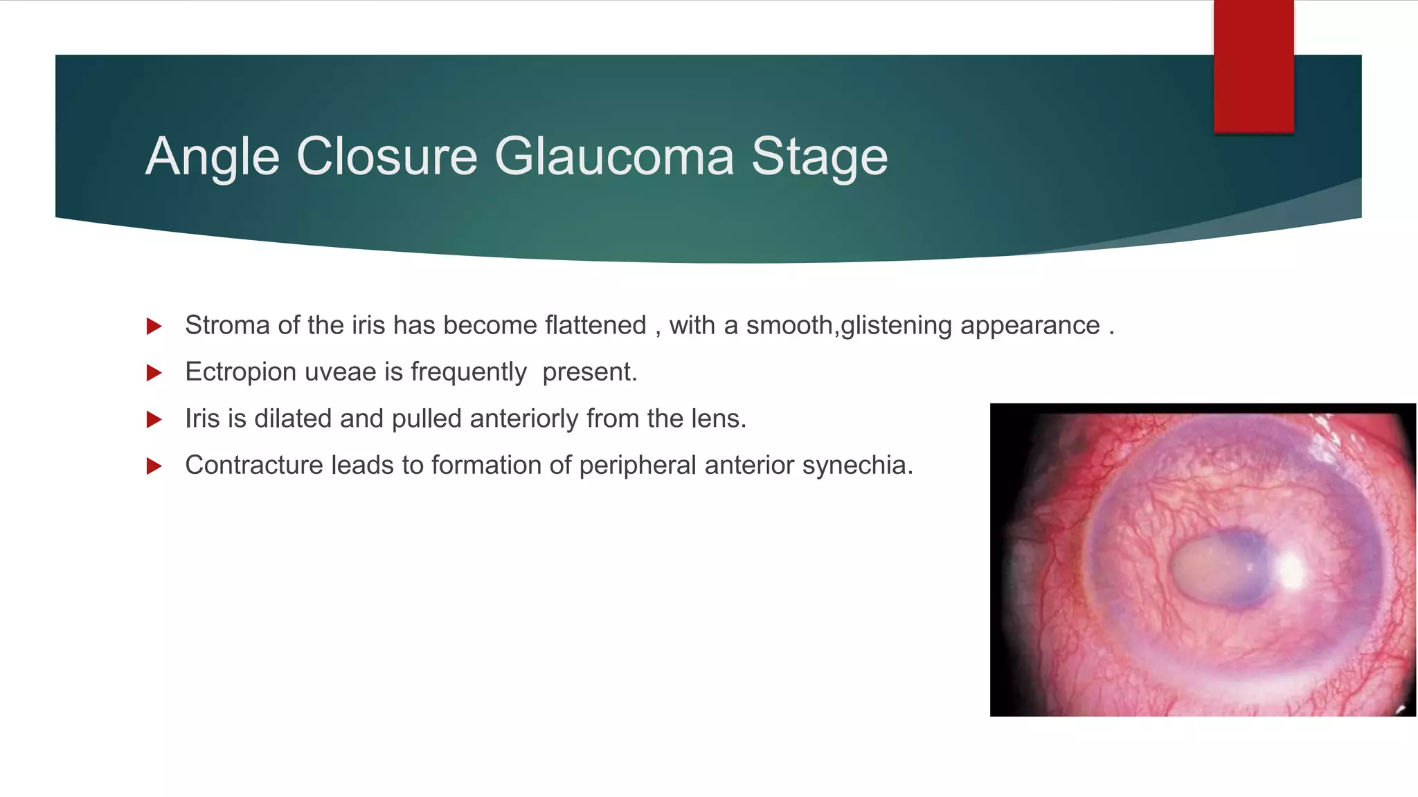 Neovascular glaucoma | PPTX