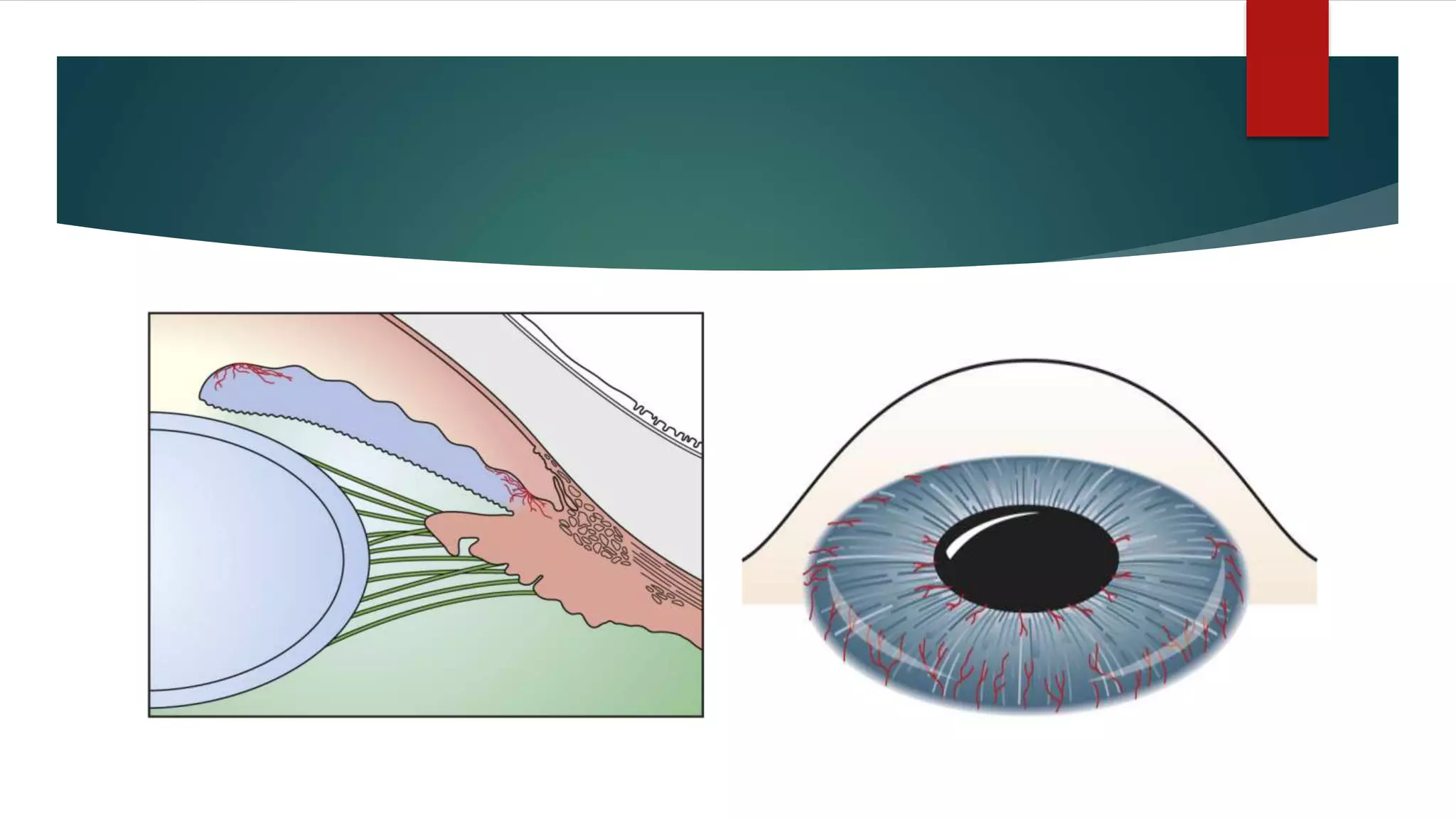 Neovascular glaucoma | PPTX