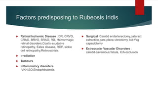 Neovascular glaucoma | PPTX