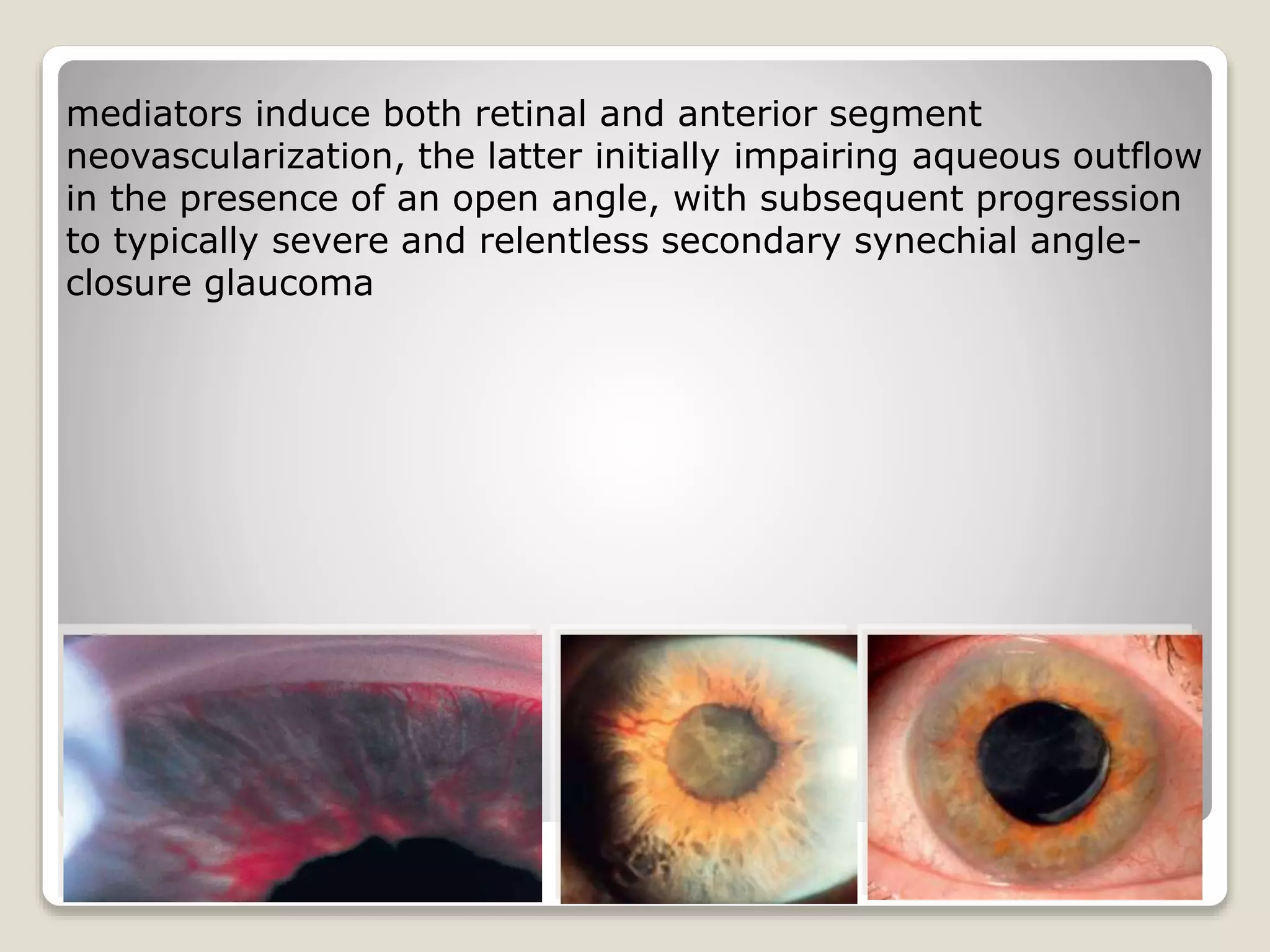 Neovascular glaucoma | PPSX