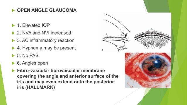 Neovascular glaucoma (NVG) | PPTX