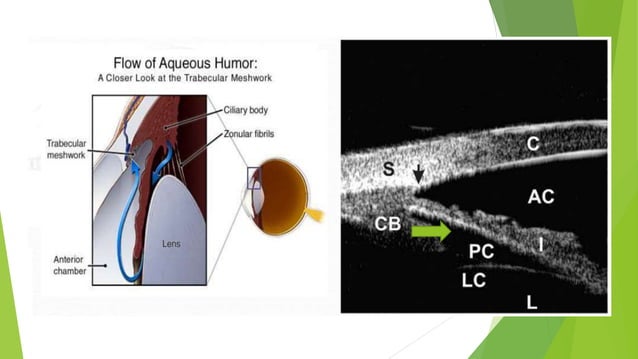 Neovascular glaucoma (NVG) | PPTX