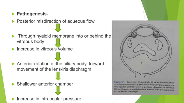 Neovascular glaucoma (NVG) | PPTX