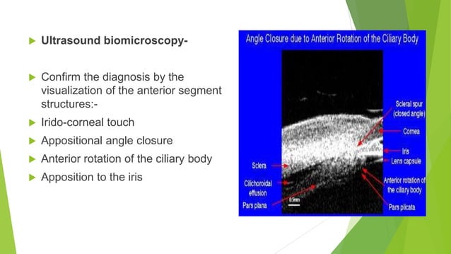 Neovascular glaucoma (NVG) | PPTX