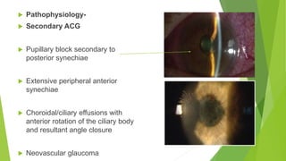 Neovascular glaucoma (NVG) | PPTX