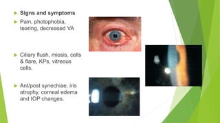 Neovascular glaucoma (NVG) | PPTX