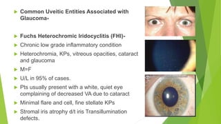 Neovascular glaucoma (NVG) | PPTX