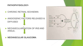 Neovascular glaucoma (NVG) | PPTX