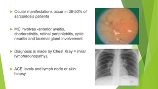 Neovascular glaucoma (NVG) | PPTX