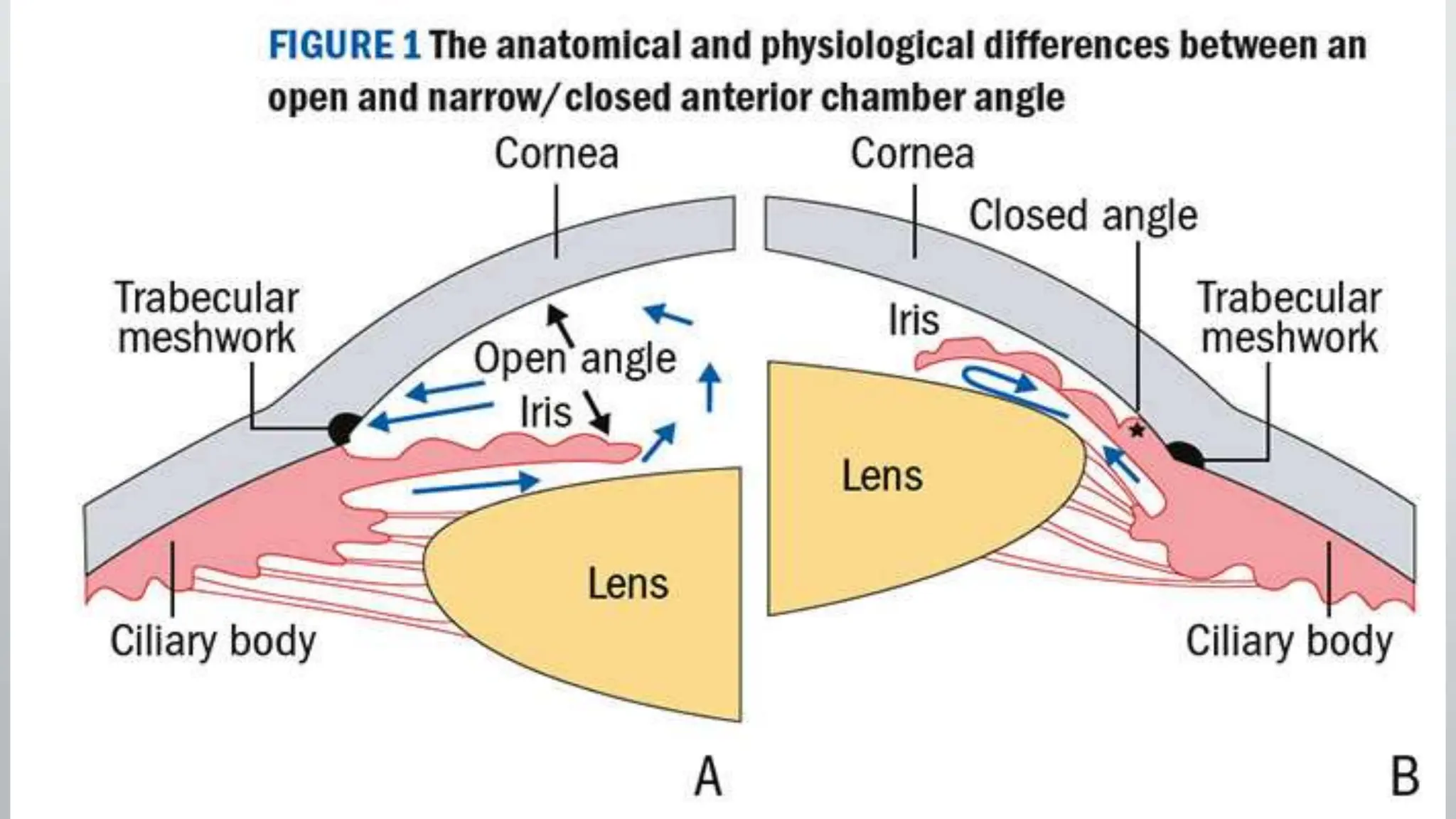 Neovascular Glaucoma presentation made easy | PPTX