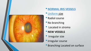 Neovascular Glaucoma presentation made easy | PPTX
