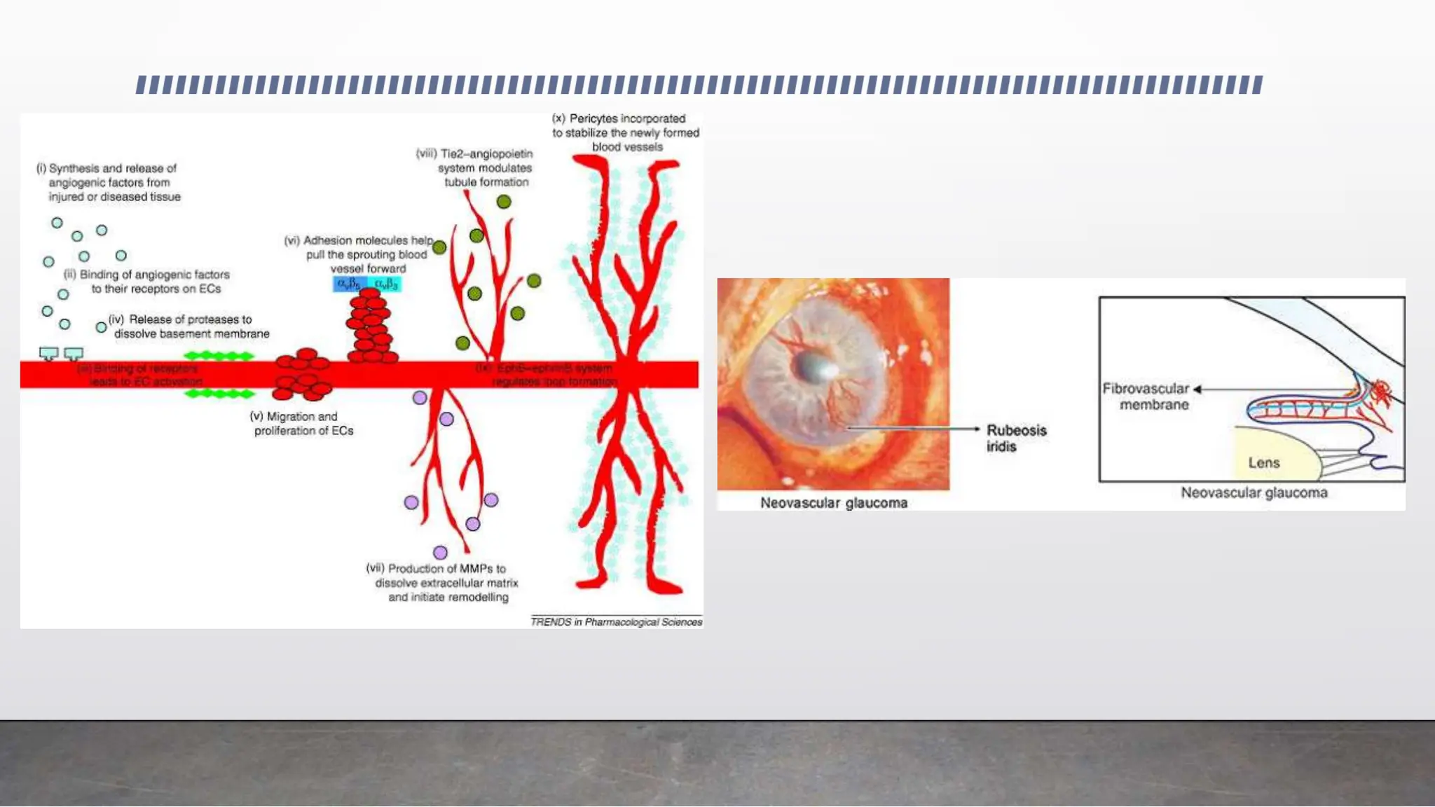 This is a case of neovascular glaucoma.pptx