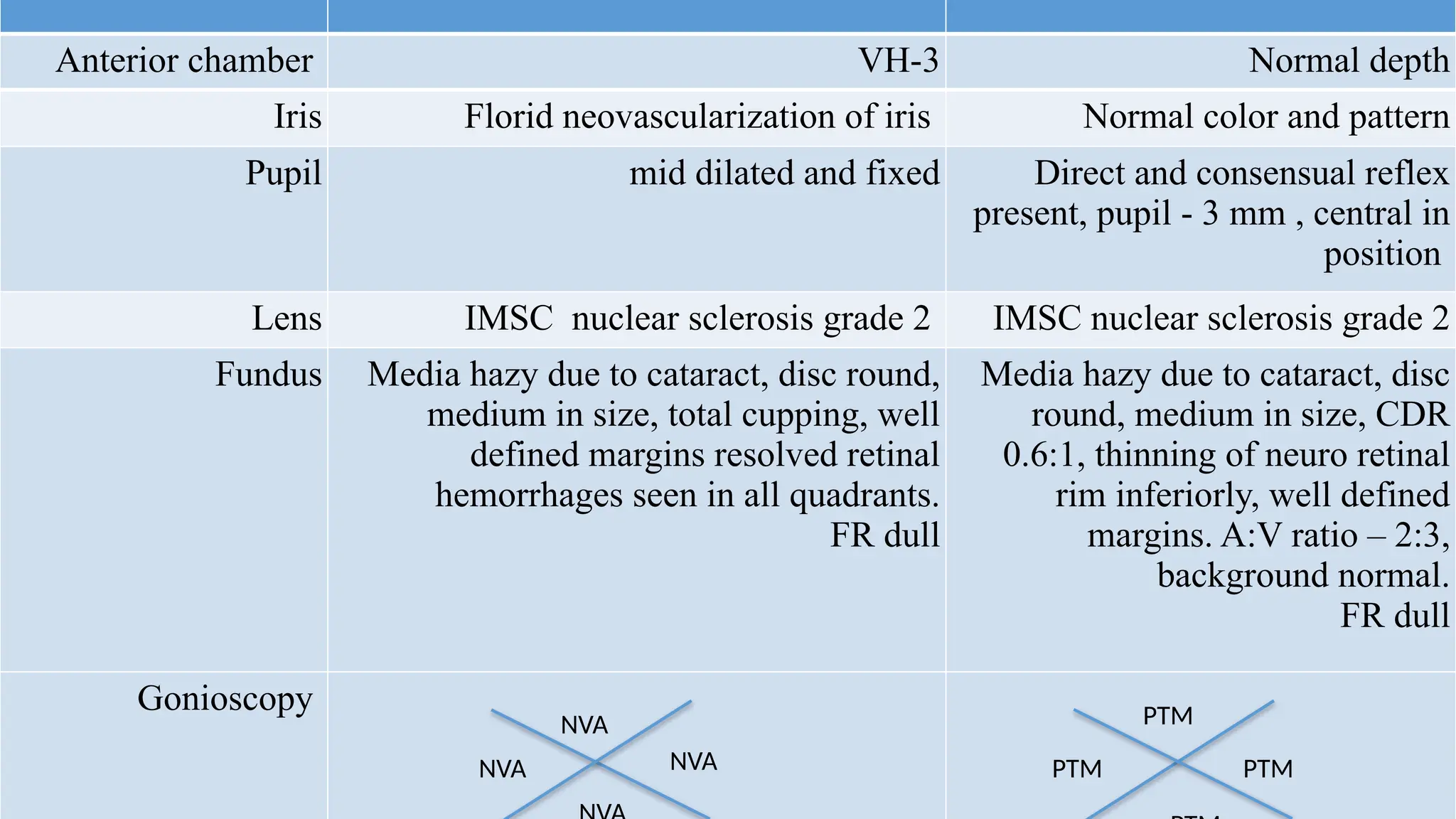 neovascular glaucoma.pptx..................... | PPTX