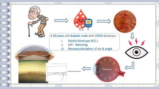 Approach to a case of Neovascular Glaucoma.pptx
