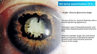 Approach to a case of Neovascular Glaucoma.pptx