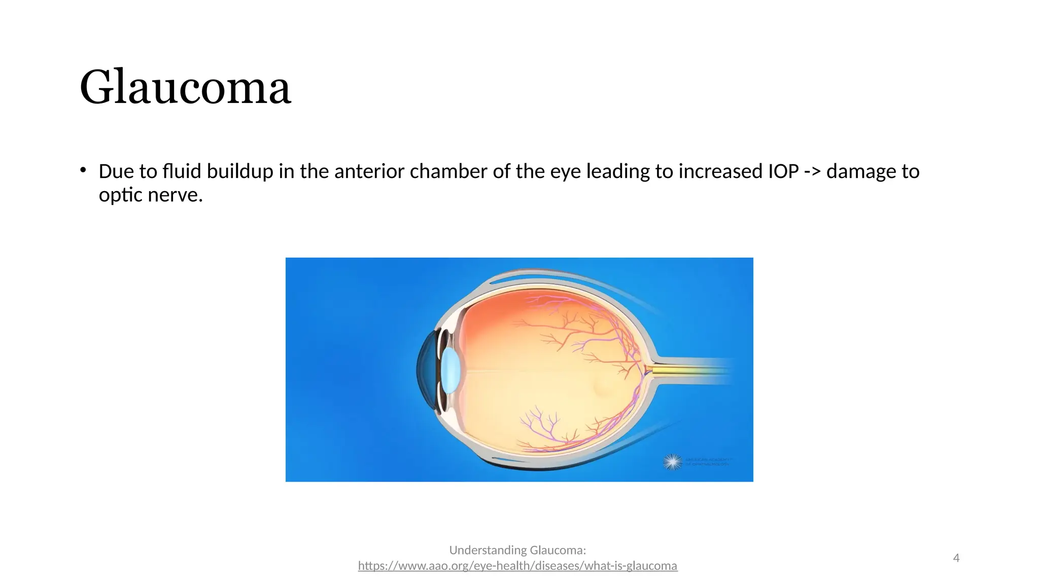 Neovascular Glaucoma ophthalmology medicine | PPTX