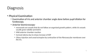 Neovascular Glaucoma ophthalmology medicine | PPTX