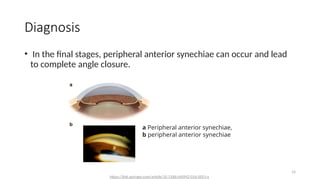 Neovascular Glaucoma ophthalmology medicine | PPTX