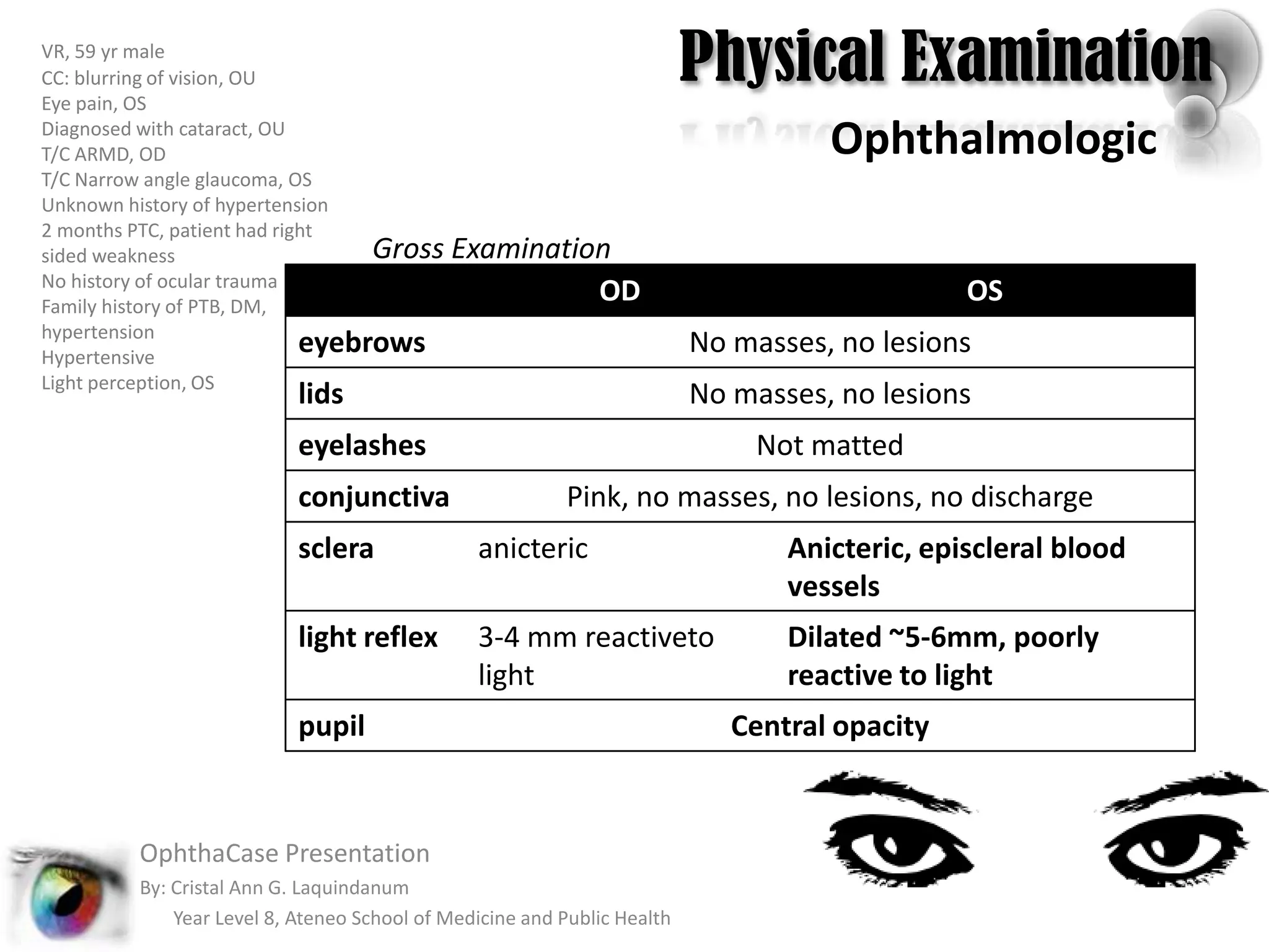 Neovascular glaucoma | PPTX | Eye and Vision Conditions | Diseases and ...