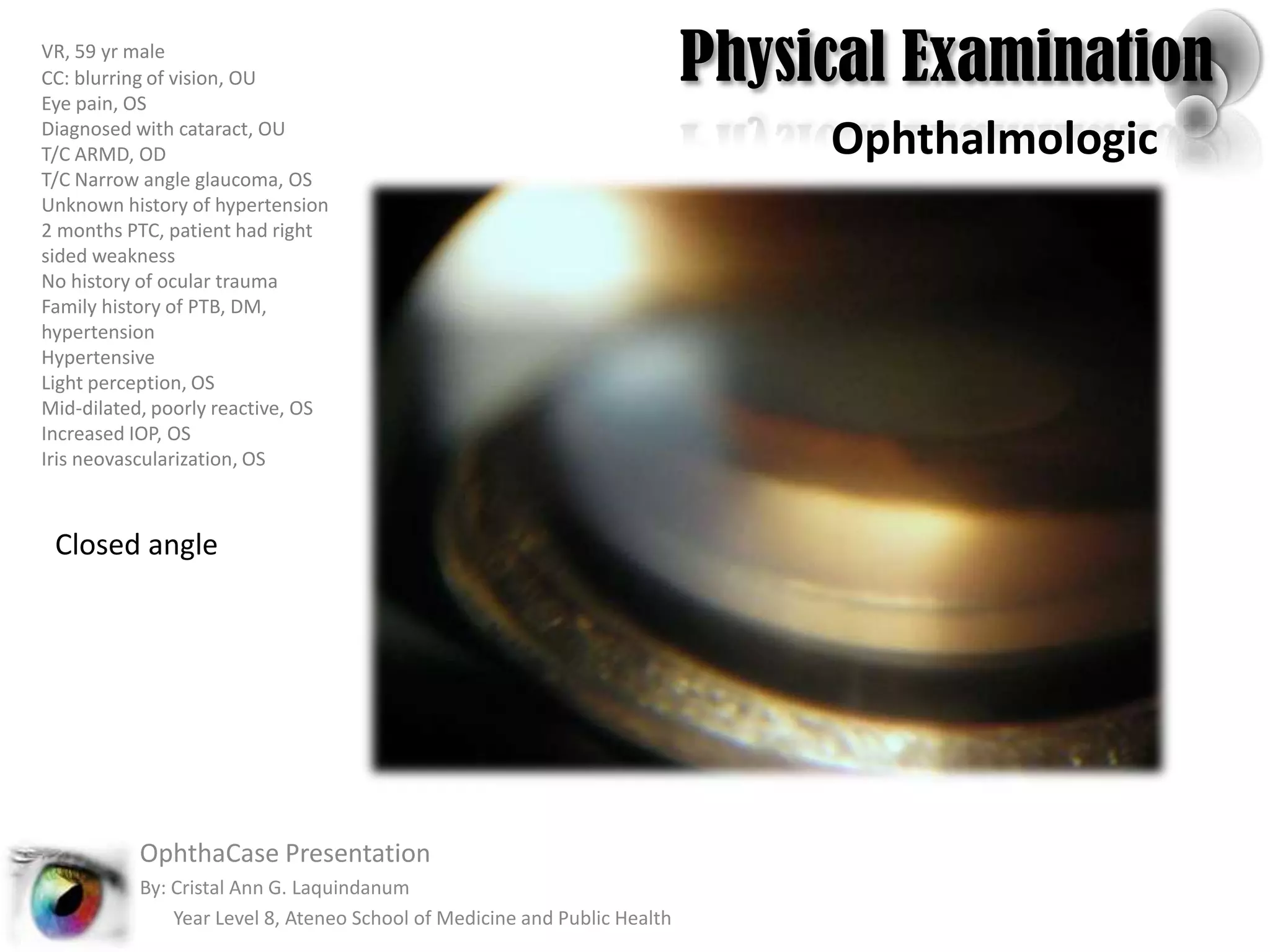Neovascular glaucoma | PPTX | Eye and Vision Conditions | Diseases and Conditions