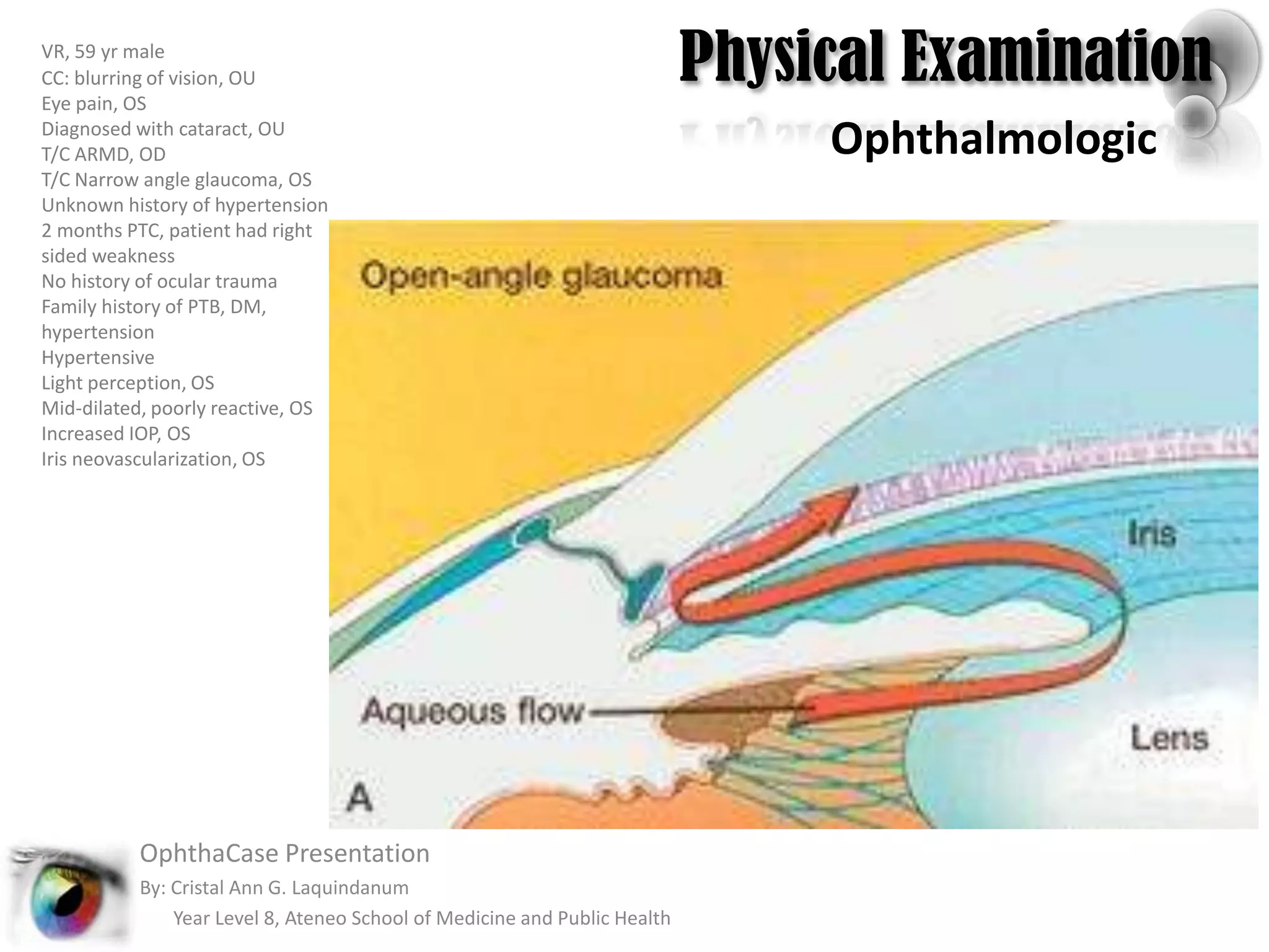 Neovascular glaucoma | PPTX | Eye and Vision Conditions | Diseases and Conditions