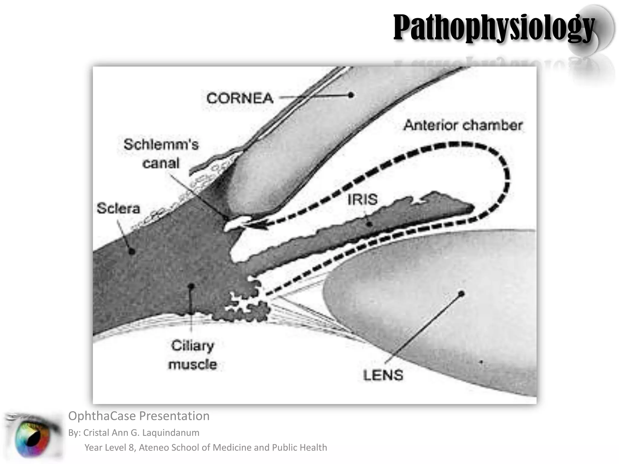 Neovascular glaucoma | PPTX | Eye and Vision Conditions | Diseases and ...