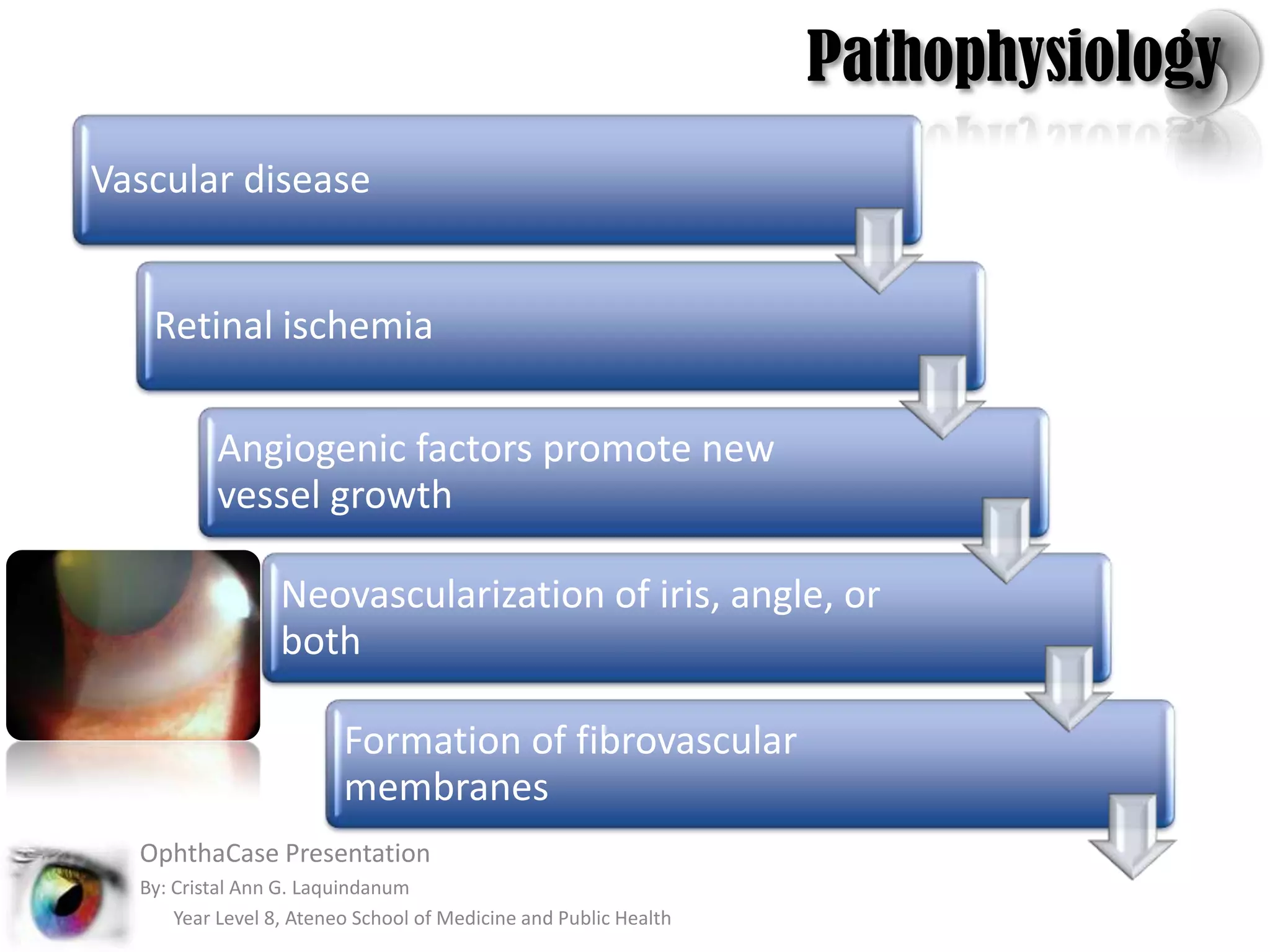 Neovascular glaucoma | PPTX | Eye and Vision Conditions | Diseases and ...