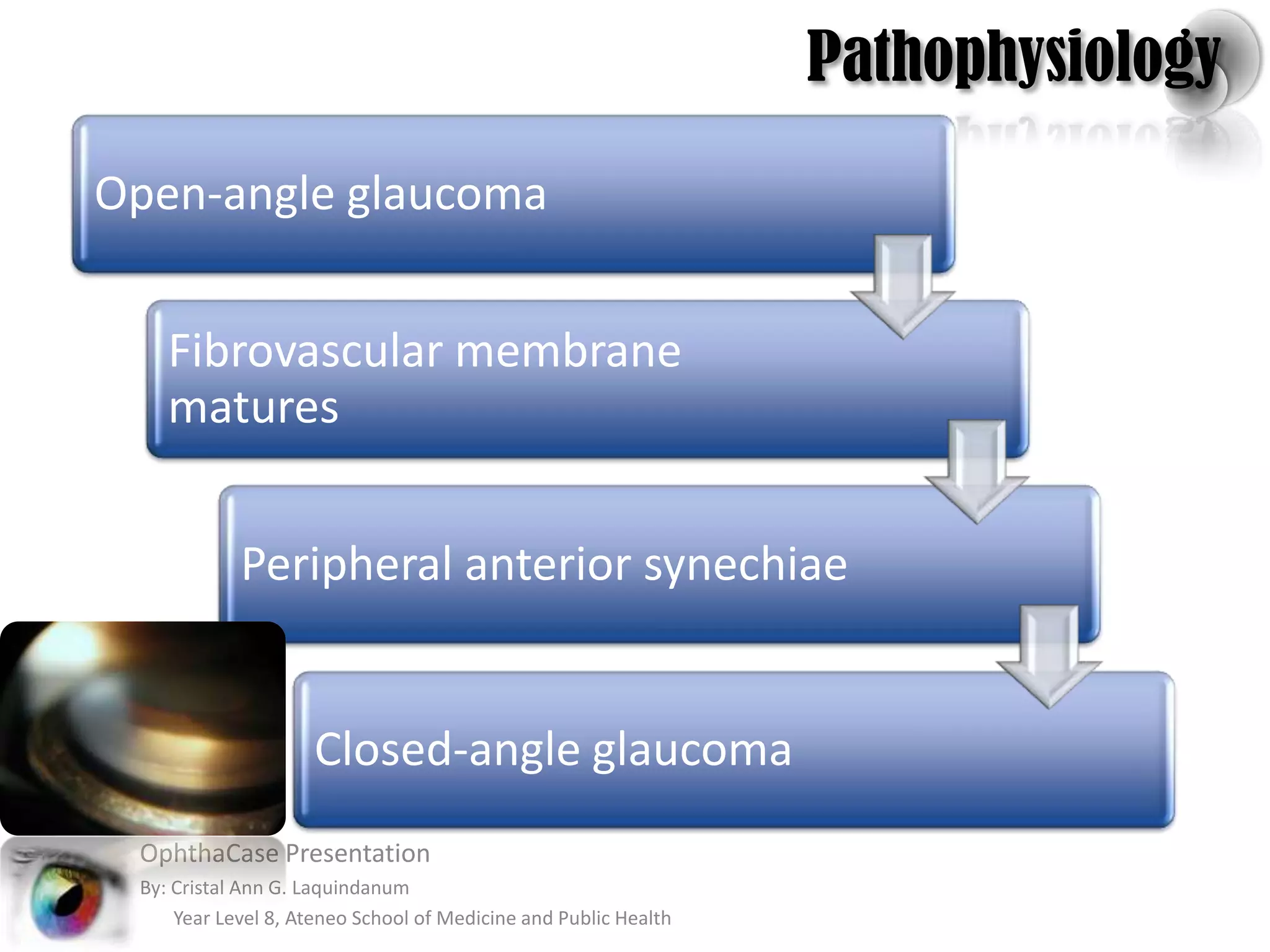 Neovascular glaucoma | PPTX | Eye and Vision Conditions | Diseases and Conditions