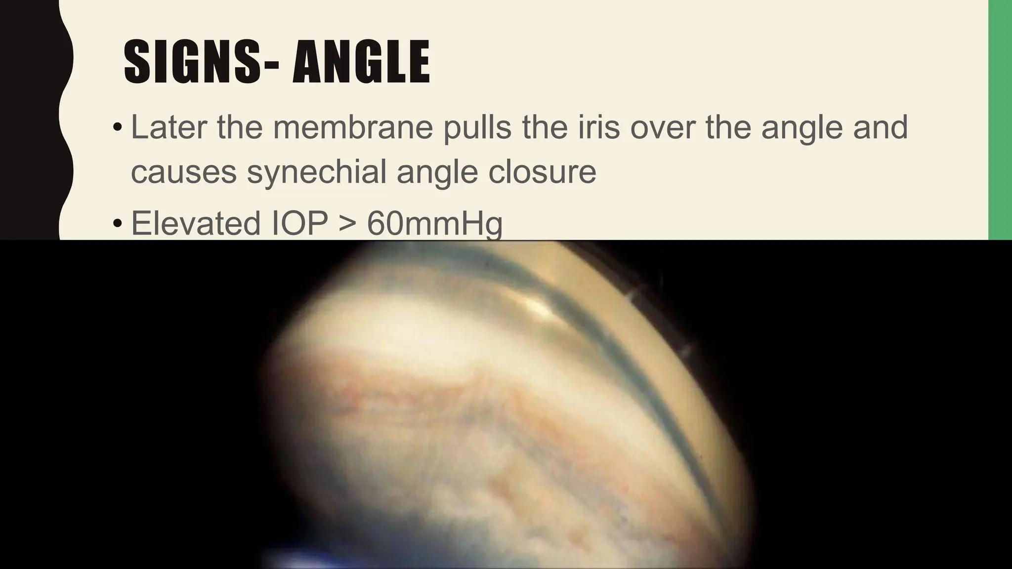 NeoVascular Glaucoma final.pptx