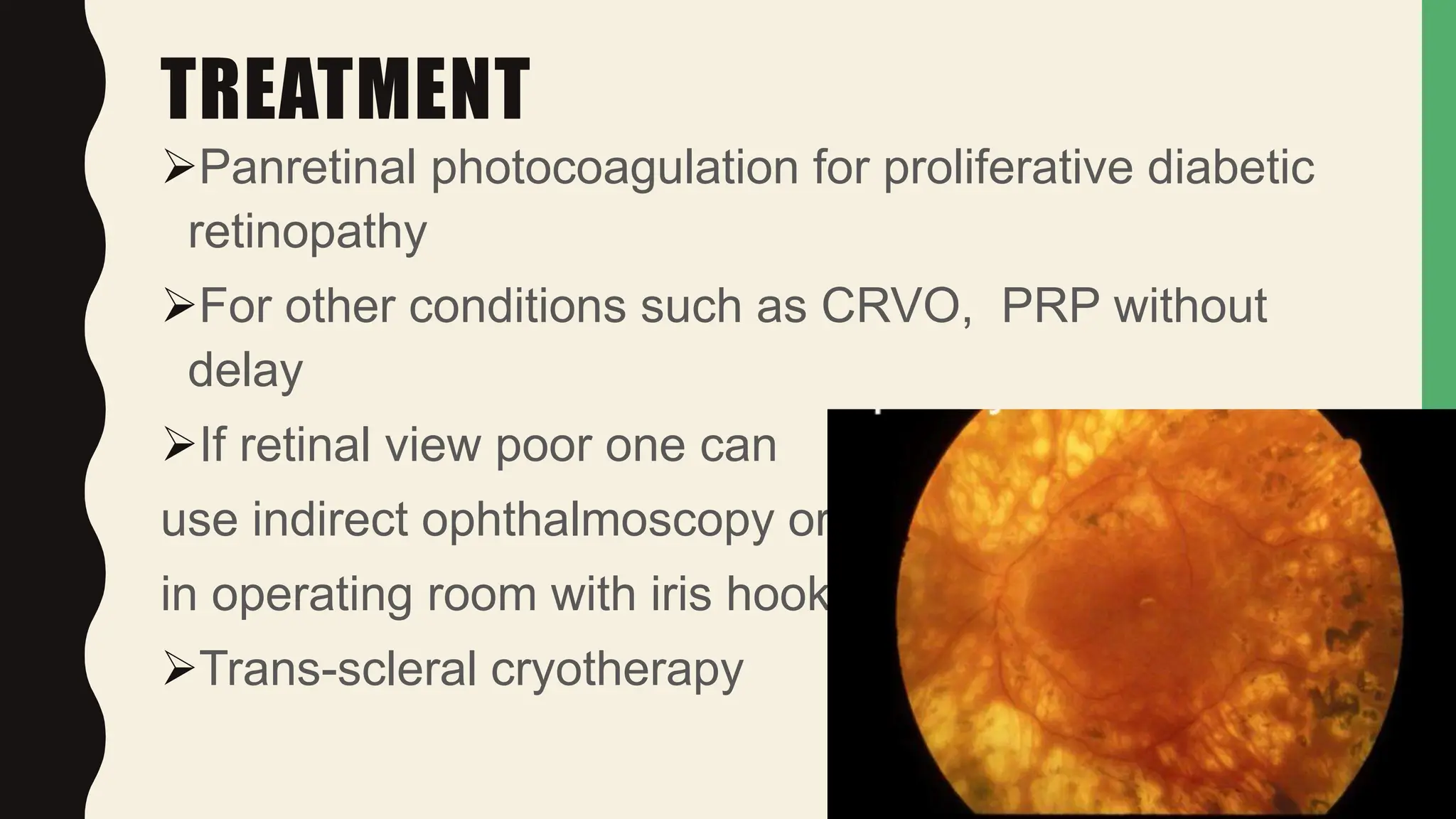 NeoVascular Glaucoma final.pptx