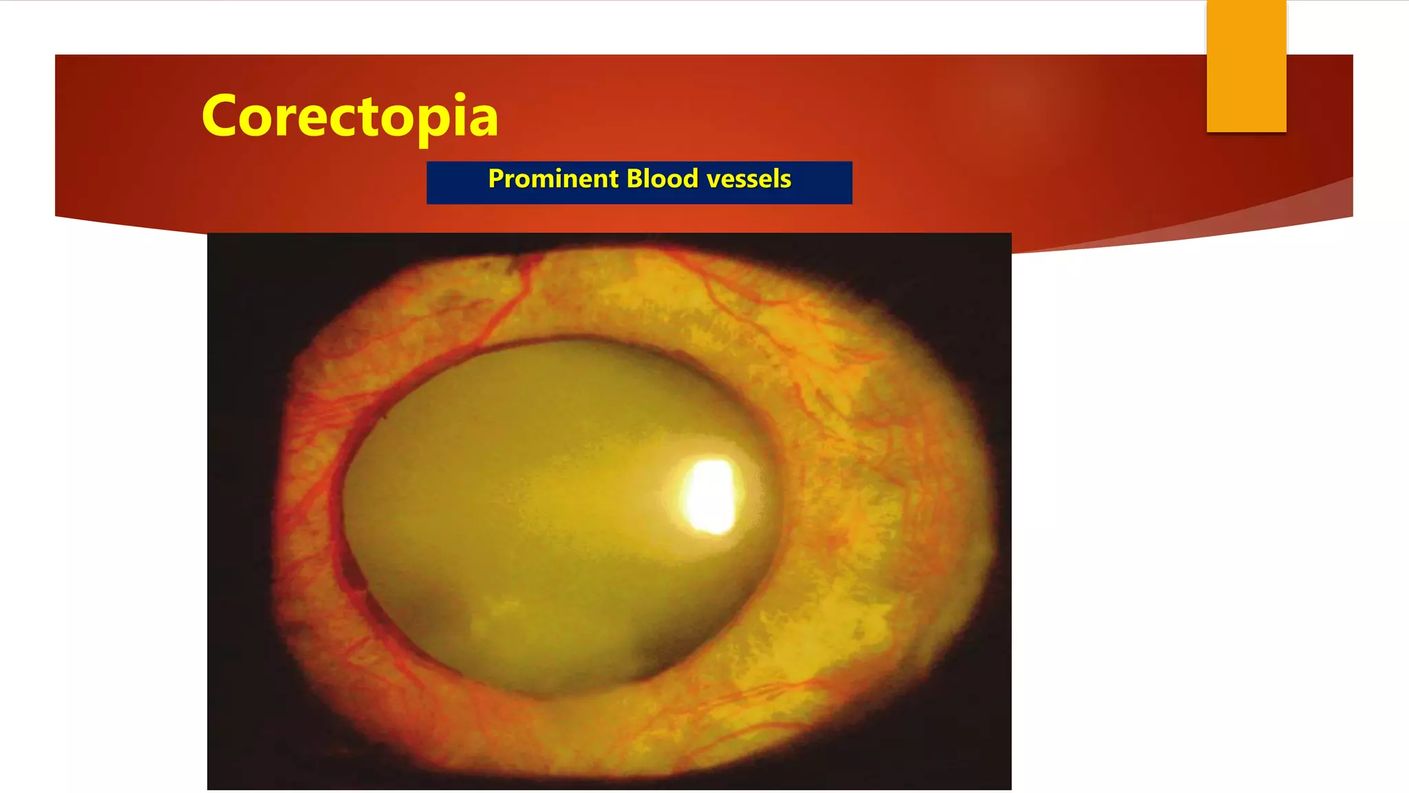 Neovascular Glaucoma .pptx