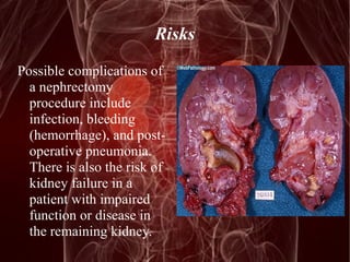 Nephrectomy | PPT