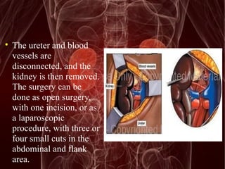 Nephrectomy | PPT