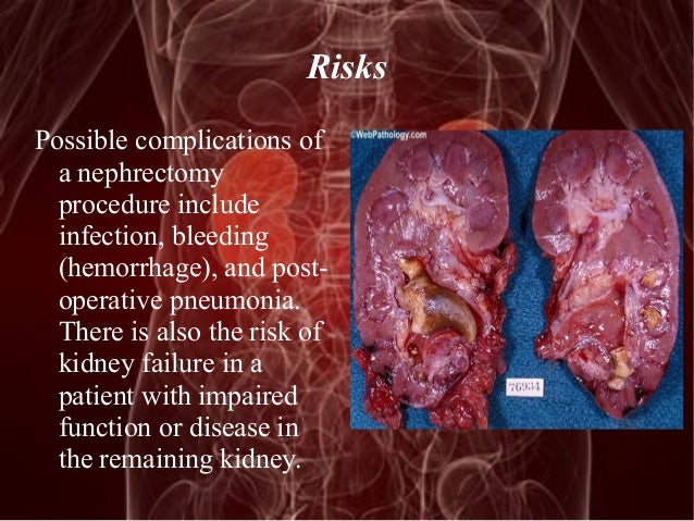 Nephrectomy