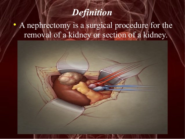 Nephrectomy