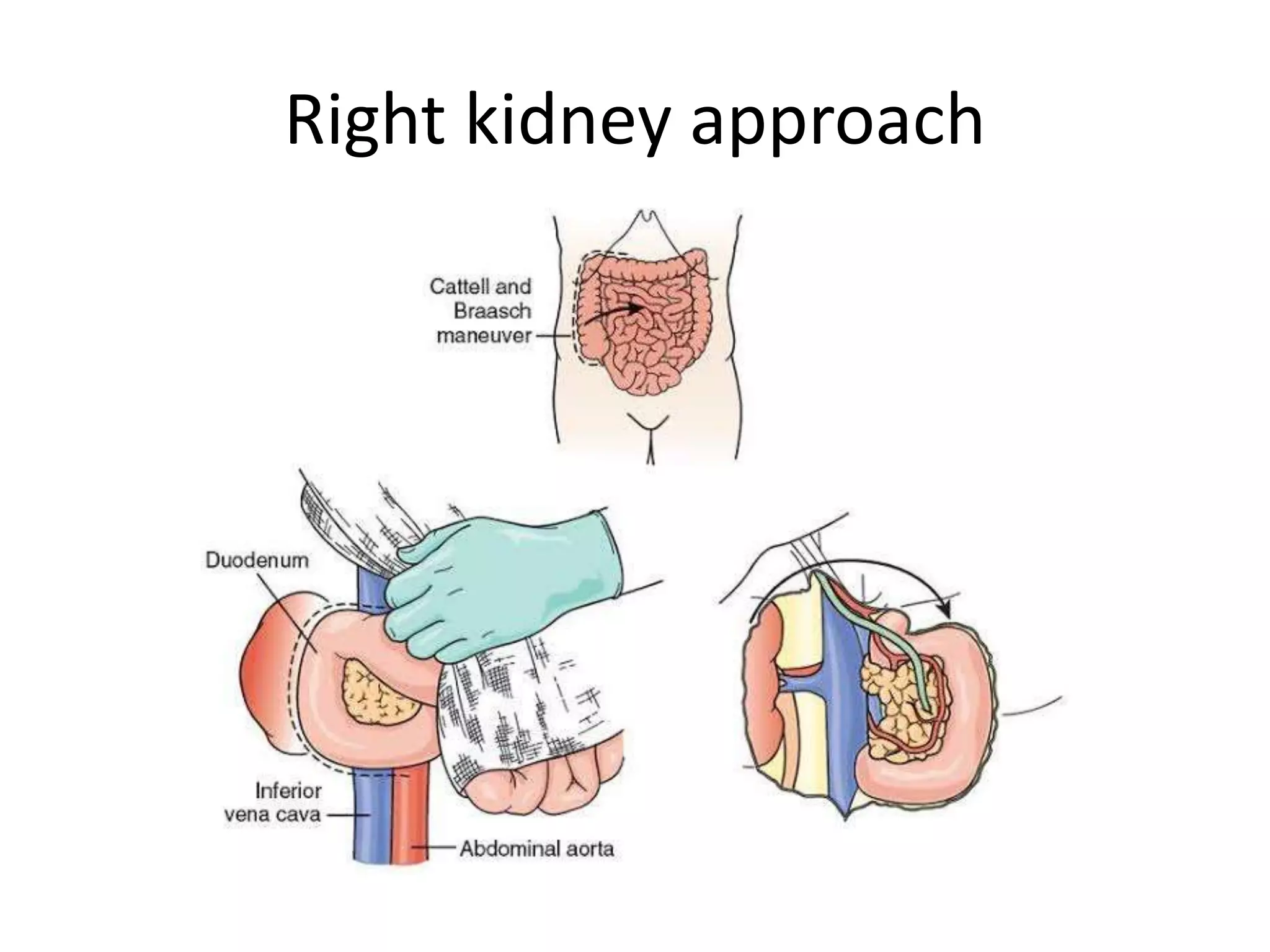 Nephrectomy : Operative Technique | PPTX