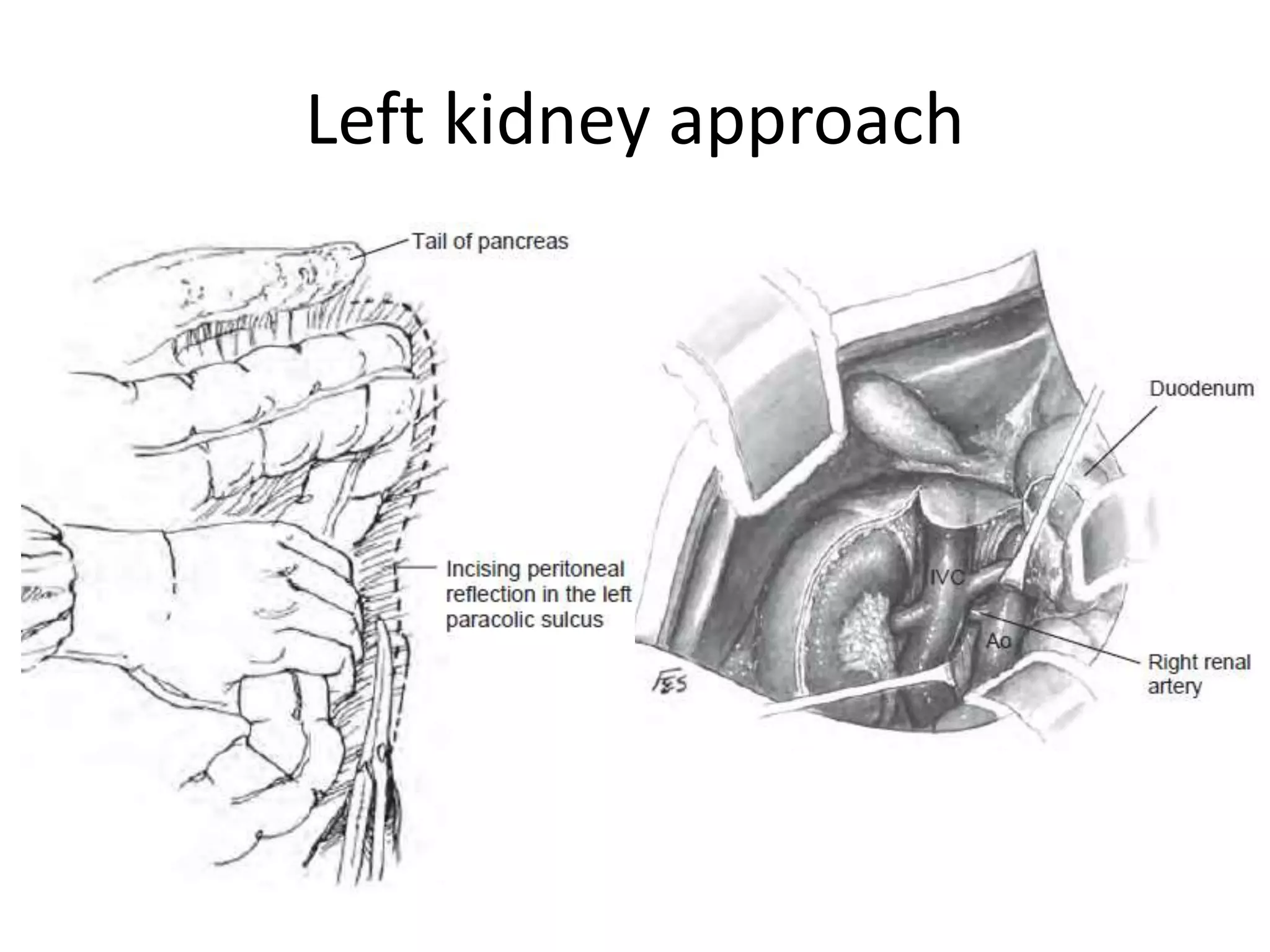 Nephrectomy : Operative Technique | PPTX