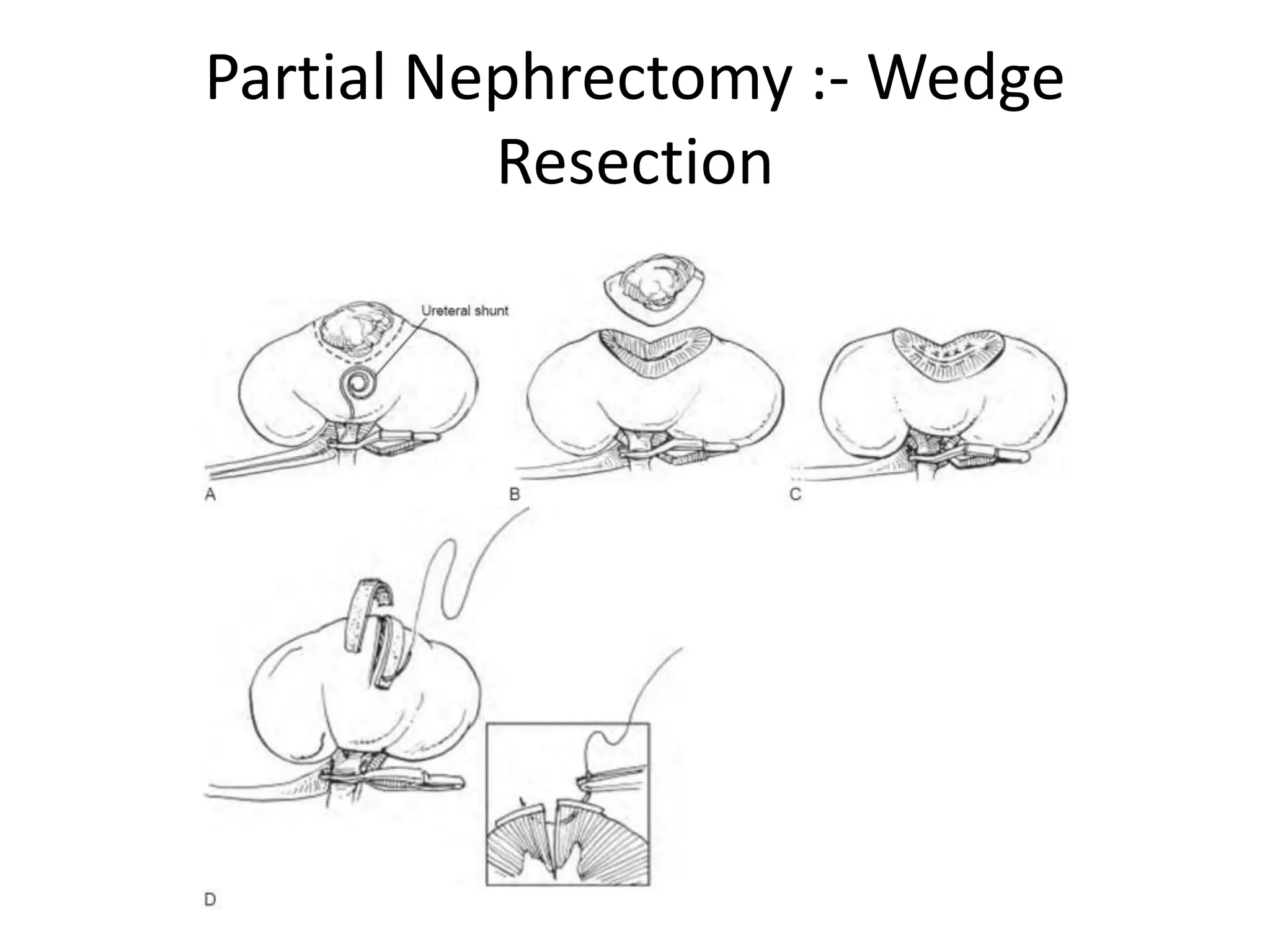 Nephrectomy : Operative Technique | PPTX