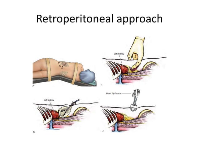 Nephrectomy : Operative Technique | PPTX | Death, Injury, or Military Conflict | Sensitive Topics
