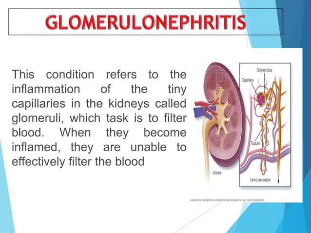 Nephritis | PPTX