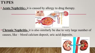 Nephritis.pptx