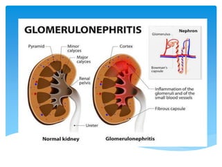 nephritis.bsc nursing third year kcon.... | PPTX