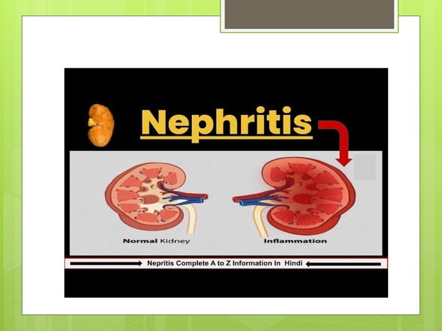 NEPHRITIS AND ITS NURSING MANAGEMENT pptx | PPTX | Infectious Diseases ...