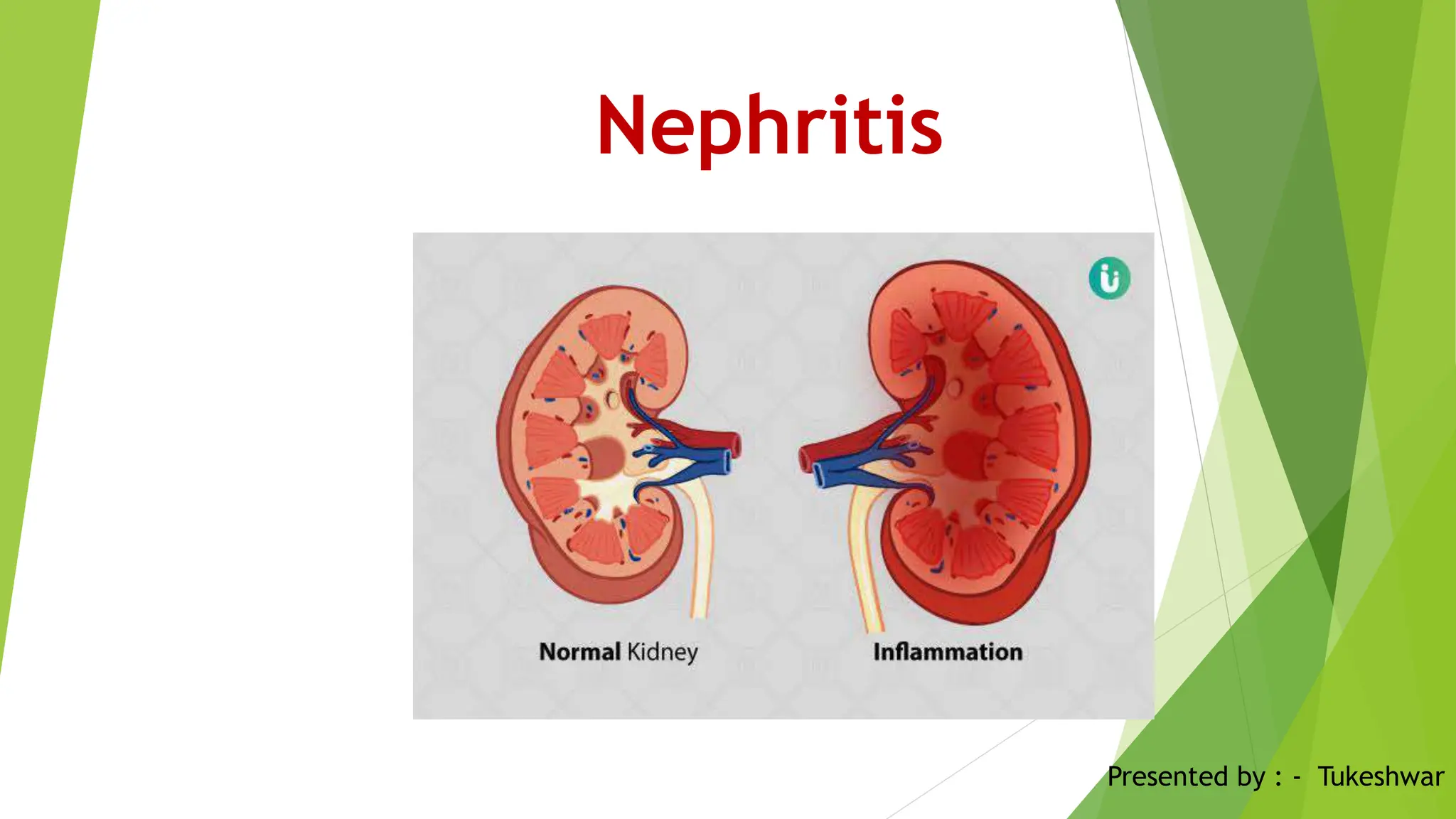 Nephritis slide share ,ppt.pptx definition , types , sign symptom, Pathophysiology | PPTX ...