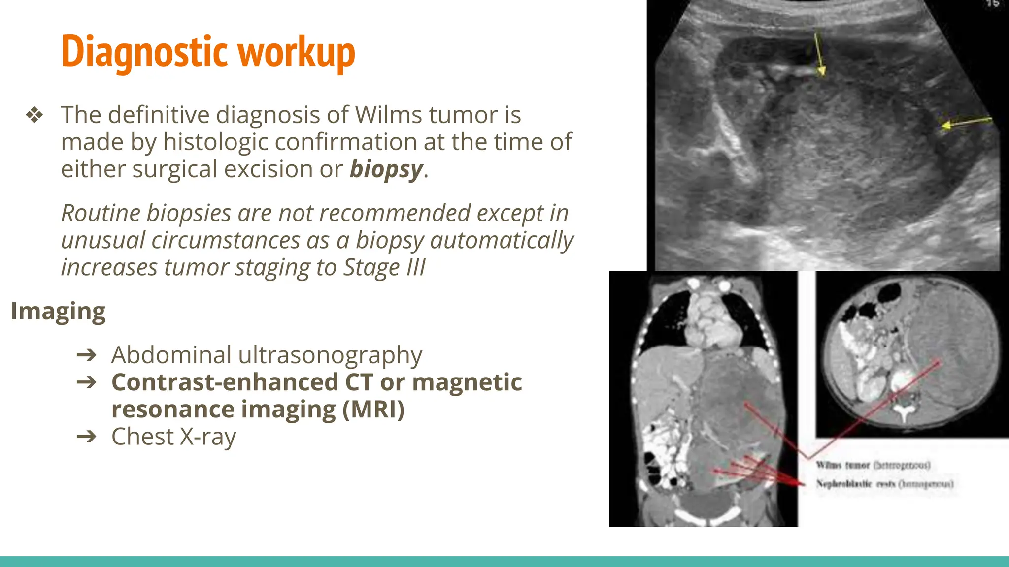 NEPHROBLASTOMA IN CHILDREN (Wilm’s tumor).pptx