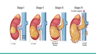 NEPHROBLASTOMA IN CHILDREN (Wilm’s tumor).pptx
