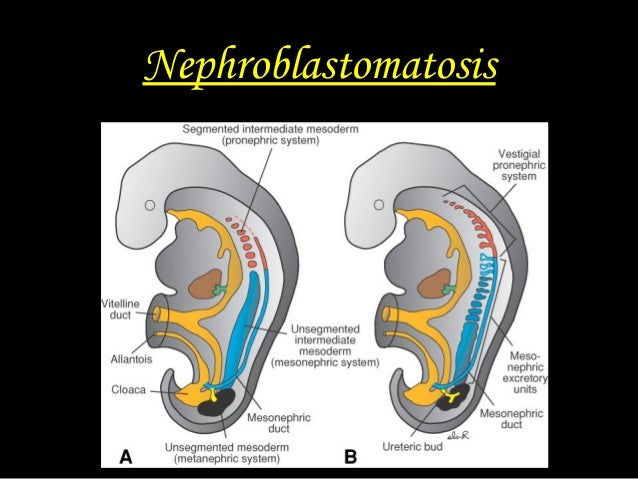 Nephroblastomatosis